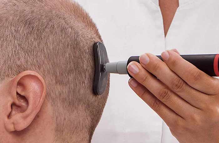 Indiba Scalp Therapy Hair Loss Treatment - Electro Theropy for Beauty ...